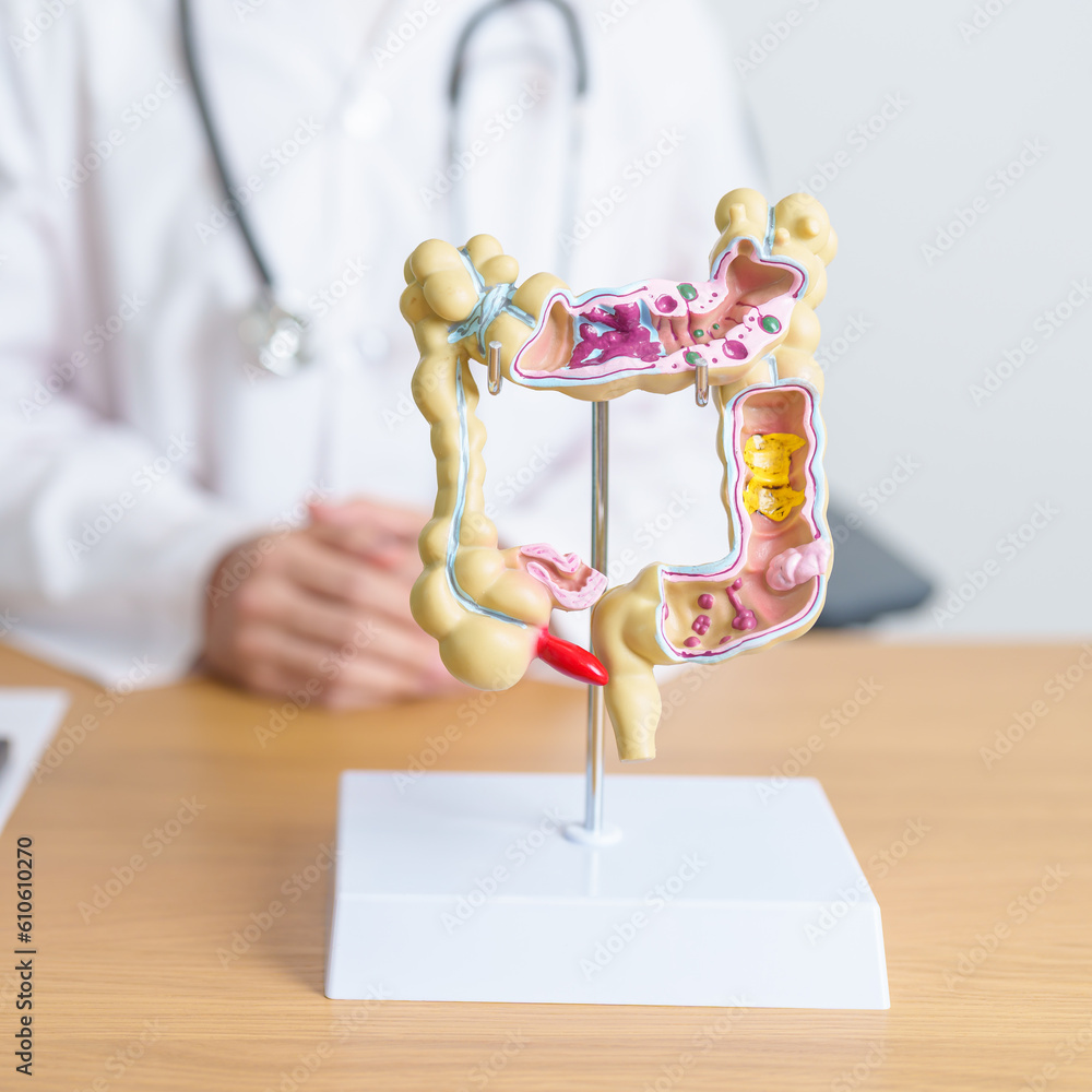 Doctor with human Colon anatomy model. Colonic disease, Large Intestine ...
