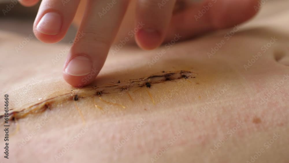 Abdomen of young girl. Closeup video of the long scar above navel after ...