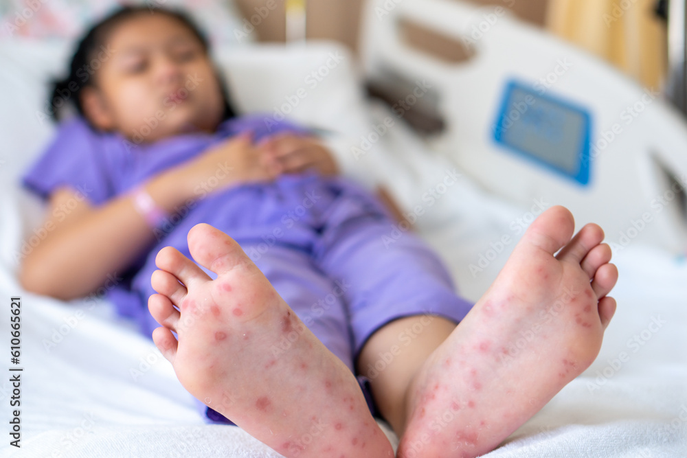 Enterovirus foot red spots blisters on the skin of on the body of a ...