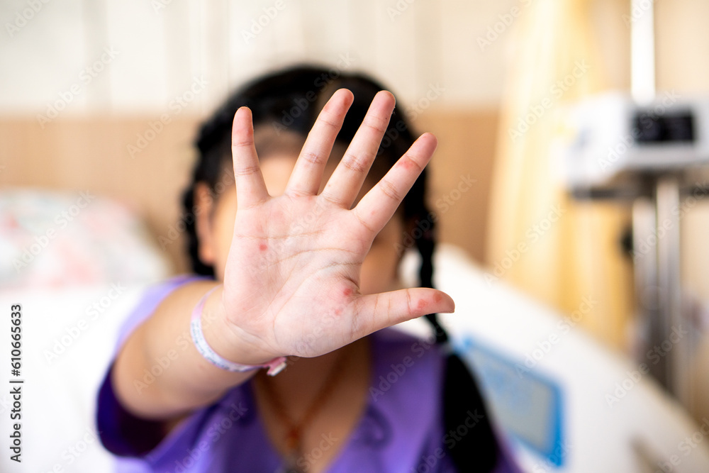 purple uniform kid show enterovirus hand red spots blisters on the skin ...