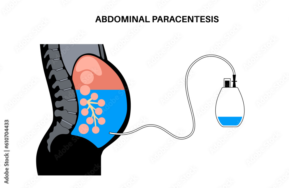 Abdominal paracentesis poster Stock Vector | Adobe Stock