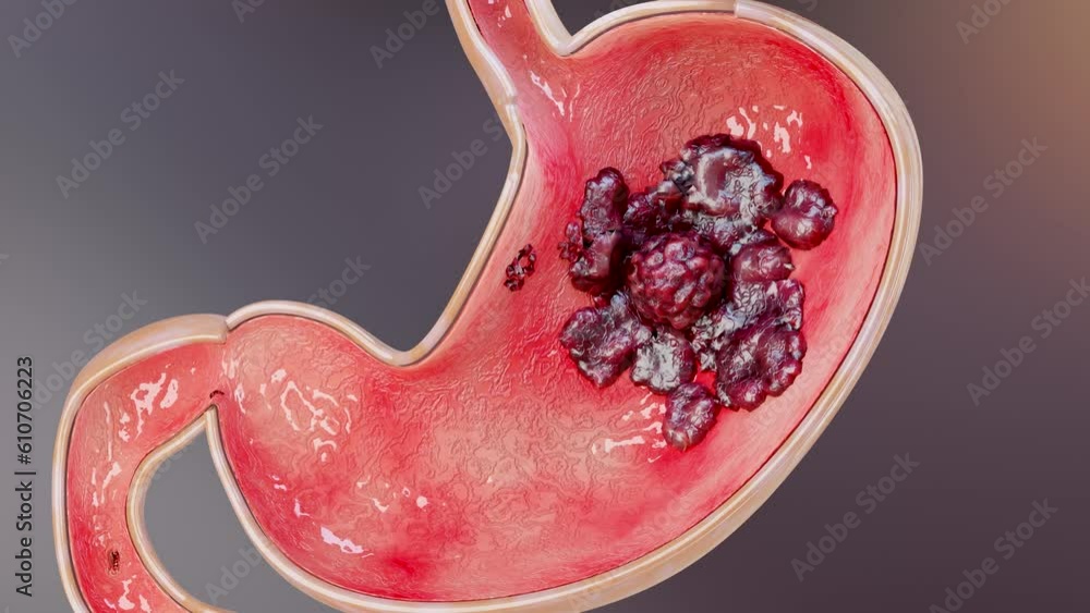 Stomach cancer. stages tumor growth in digestive system, Peptic Ulcer ...