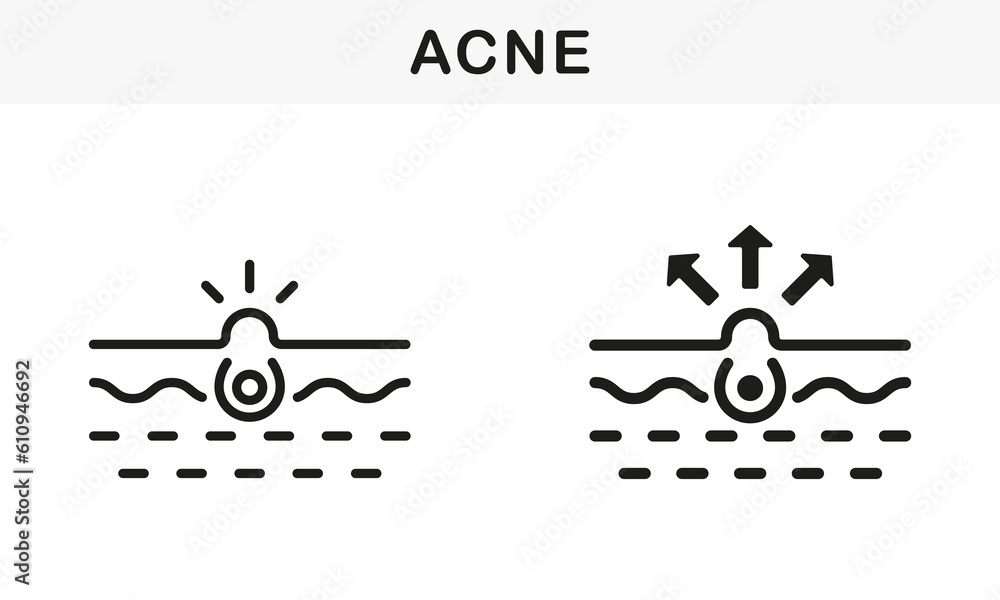 Skin Acne, Blackhead, Comedo Line and Silhouette Black Icon Set. Pimple ...