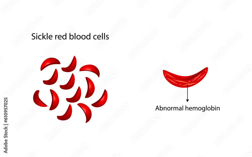 Sickle cell anemia. Sickle red blood cells. Gene mutation. Abnormal ...