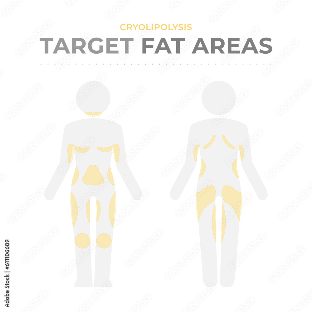 Target fat areas for Cryolipolysis. Vector infographic medical of ...