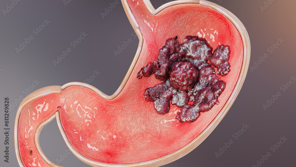 Stomach cancer. stages tumor growth in digestive system, Peptic Ulcer, Cancer attacking cell ...