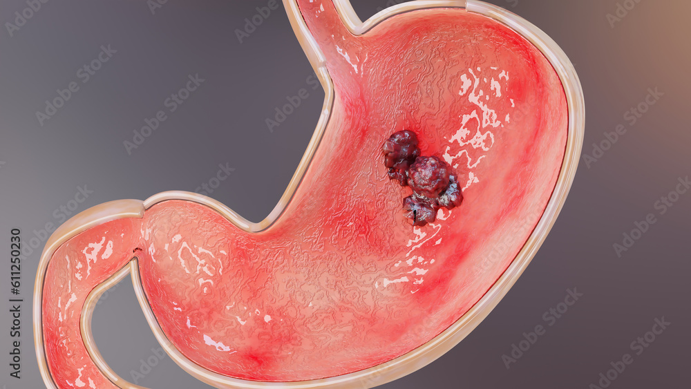 Stomach cancer. stages tumor growth in digestive system, Peptic Ulcer ...