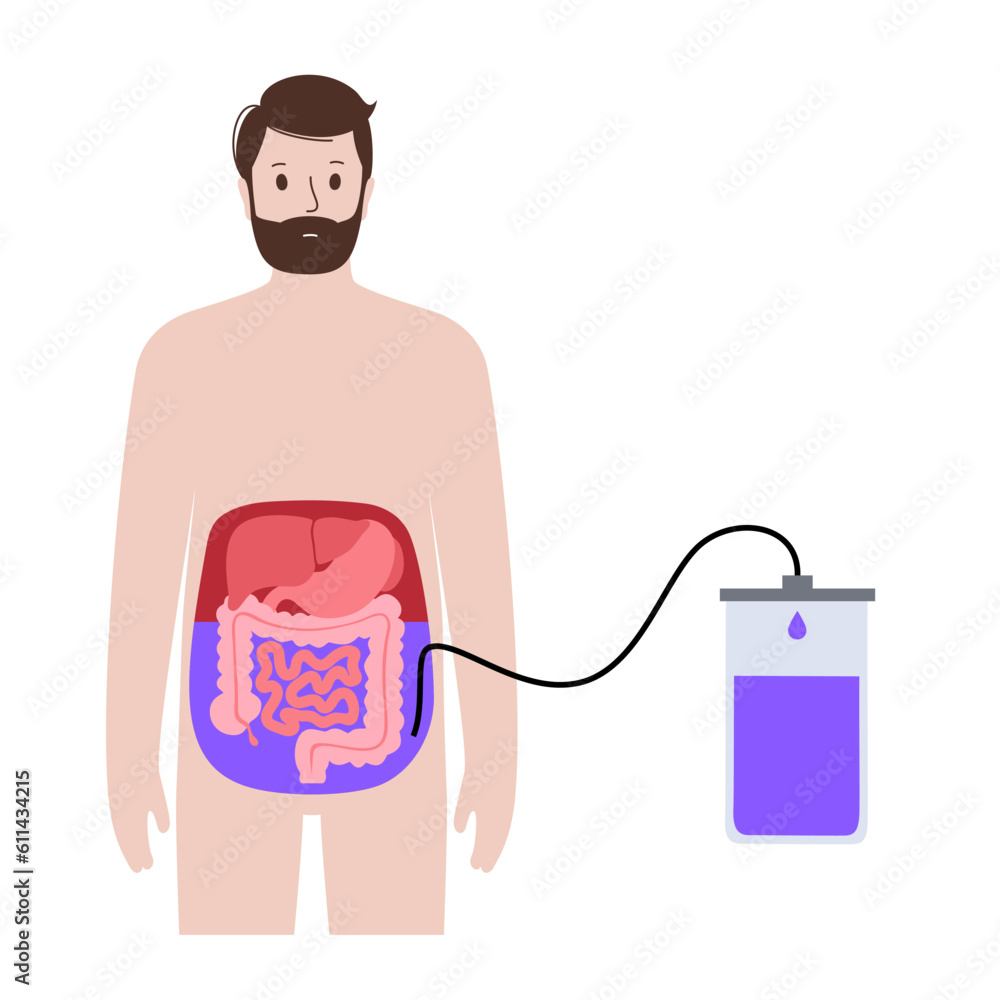 Abdominal paracentesis poster Stock Vector | Adobe Stock