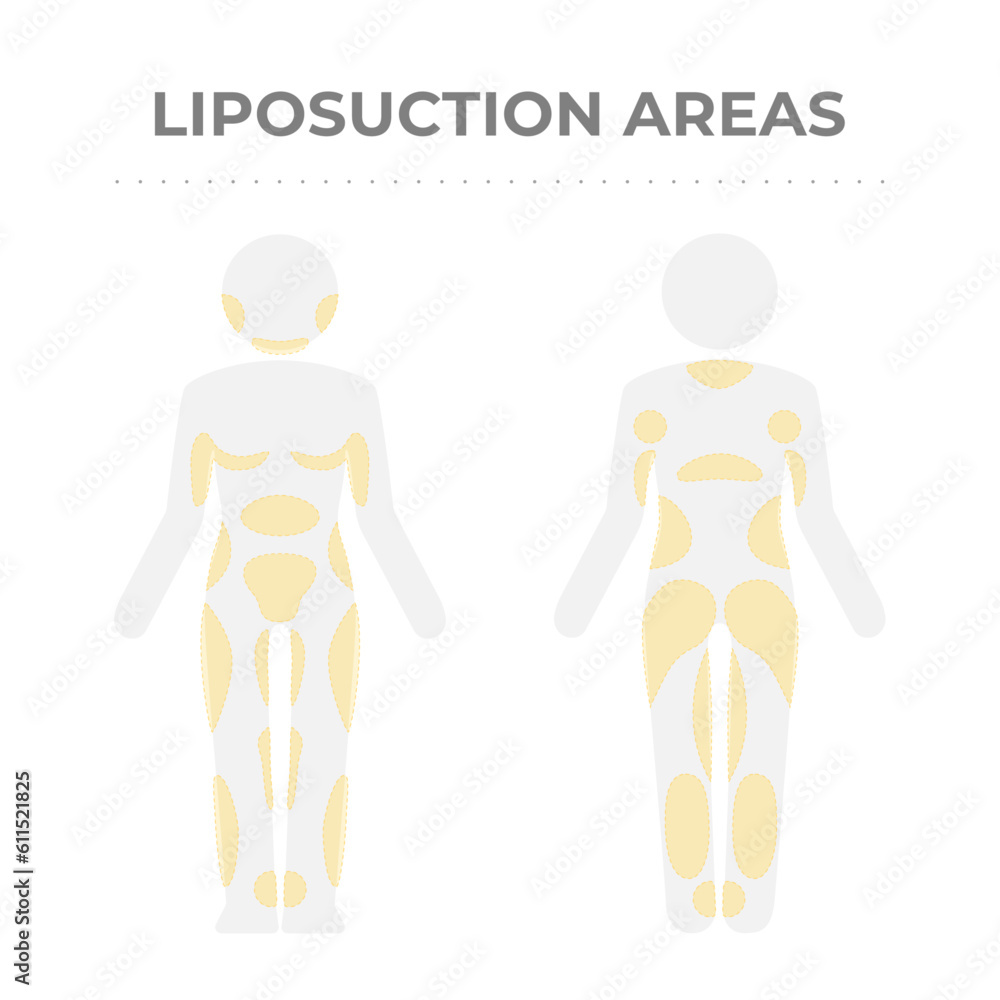 Target areas for liposuction treatment. Vector infographic medical ...