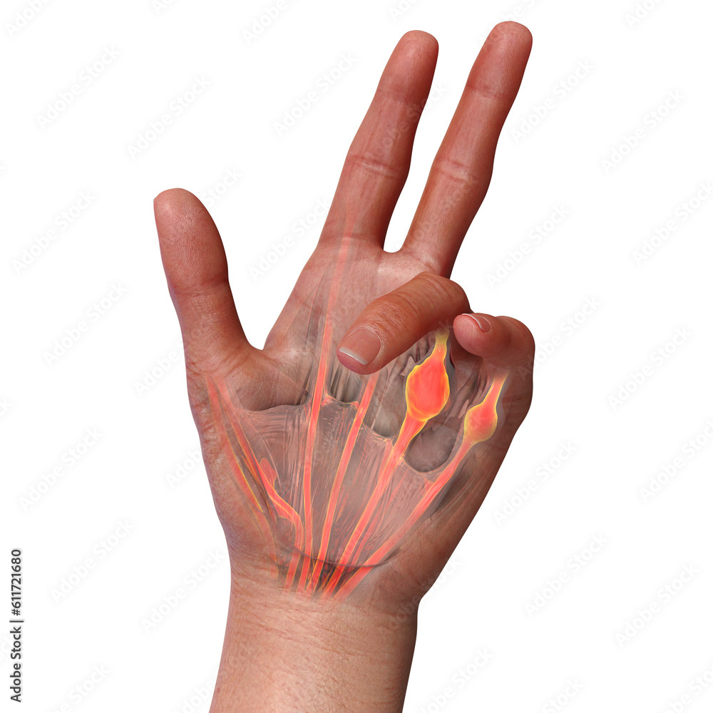 A 3D medical illustration displaying a patient's hand with Dupuytren's ...