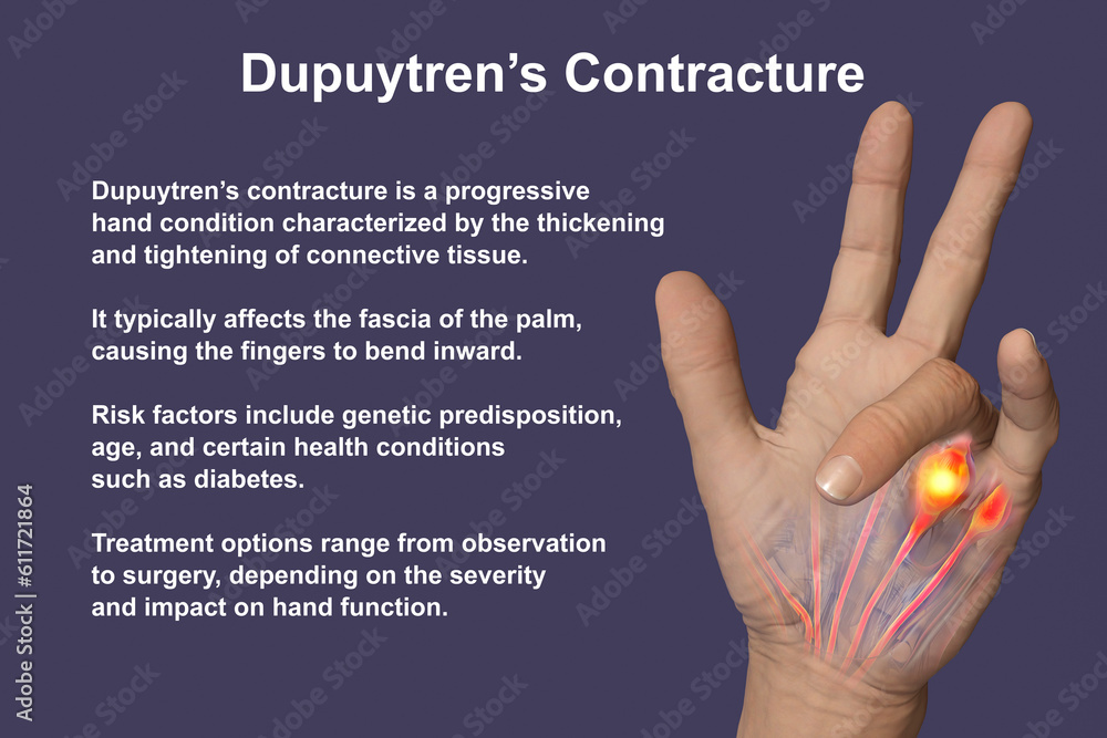 A 3D medical illustration displaying a patient's hand with Dupuytren's ...