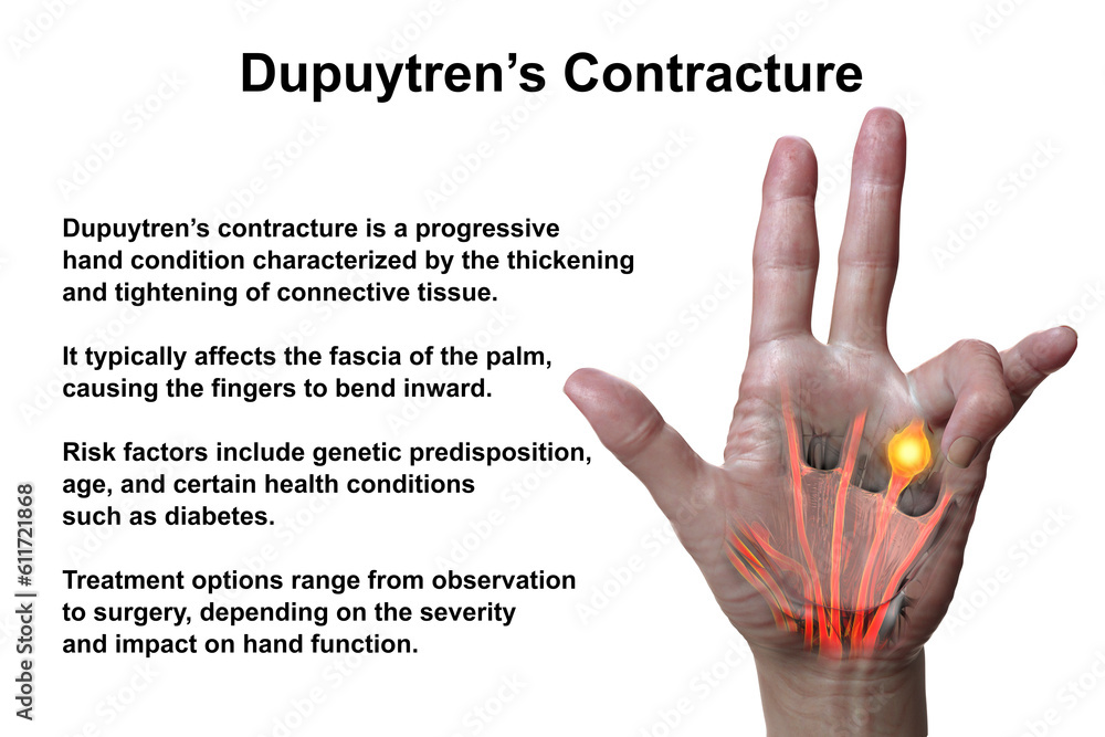 A 3D medical illustration displaying a patient's hand with Dupuytren's ...