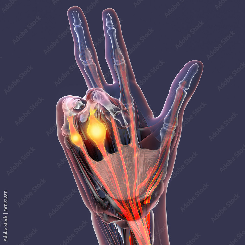 A 3D medical illustration displaying a patient's hand with Dupuytren's ...