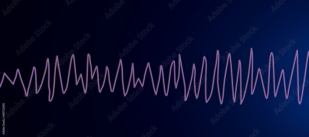 Electrocardiogram ECG displaying Torsades de pointes rhythm, 3D ...
