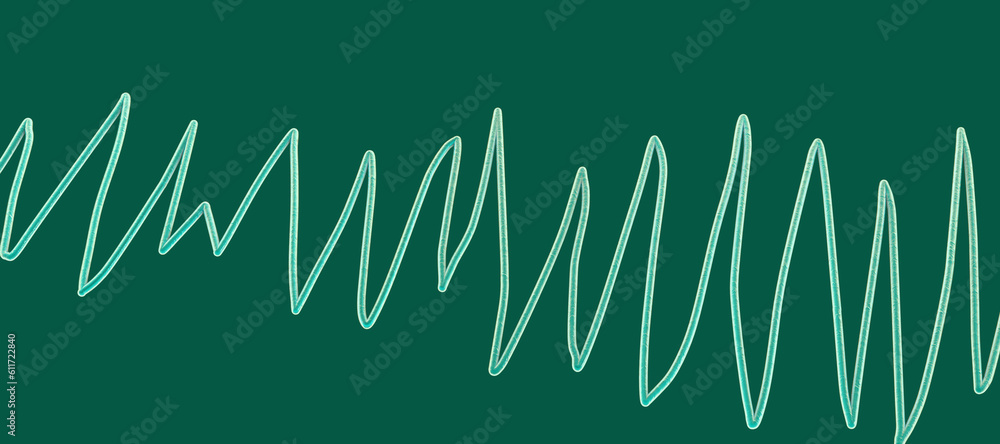 Electrocardiogram ECG displaying Torsades de pointes rhythm, 3D ...