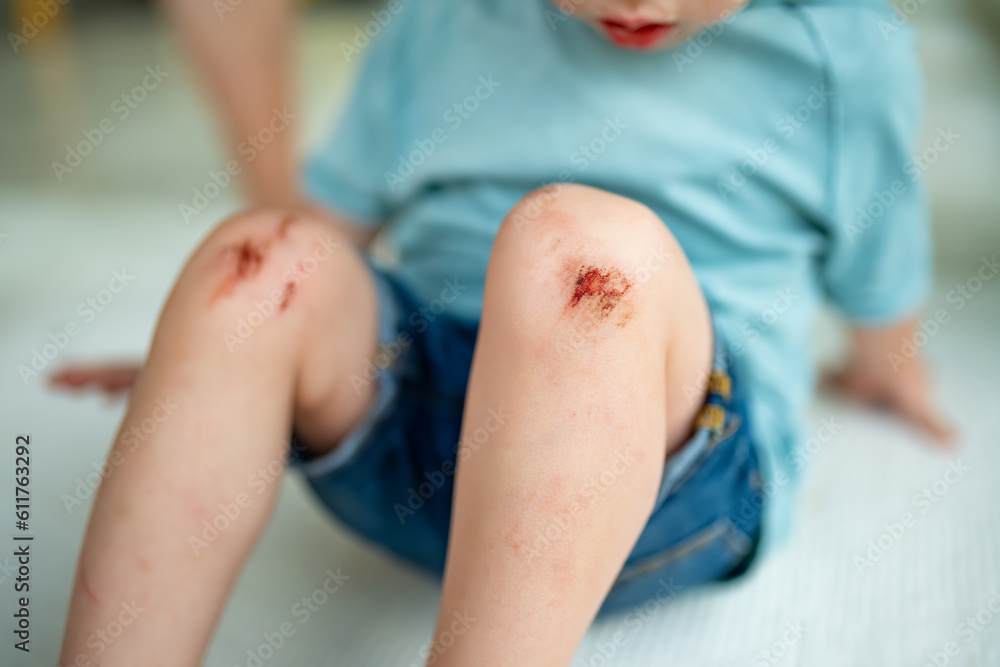 Foto de Toddler boy with scraped knees. Parent helping her child ...