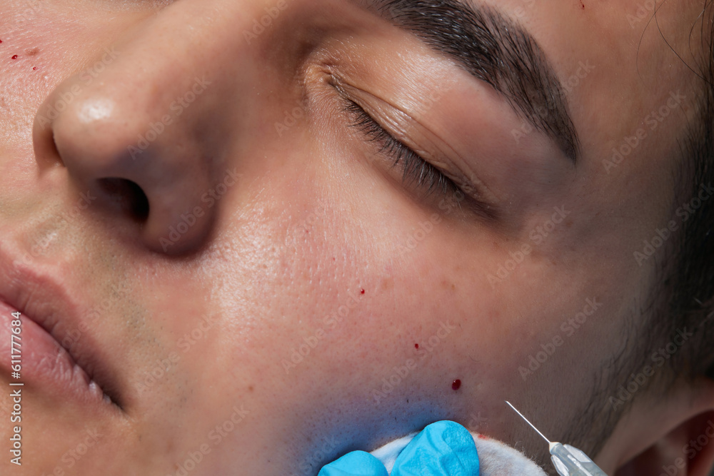 Injection at spa salon. Doctor hands in gloves. Closeup. Pretty male ...