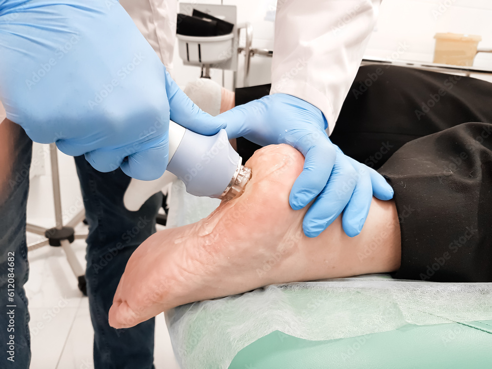 Extracorporeal shock wave therapy ESWT of heel. Visit to office of ...