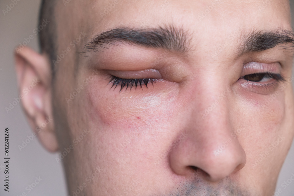 Caucasian man has angioedema around the eyes caused by allergic ...