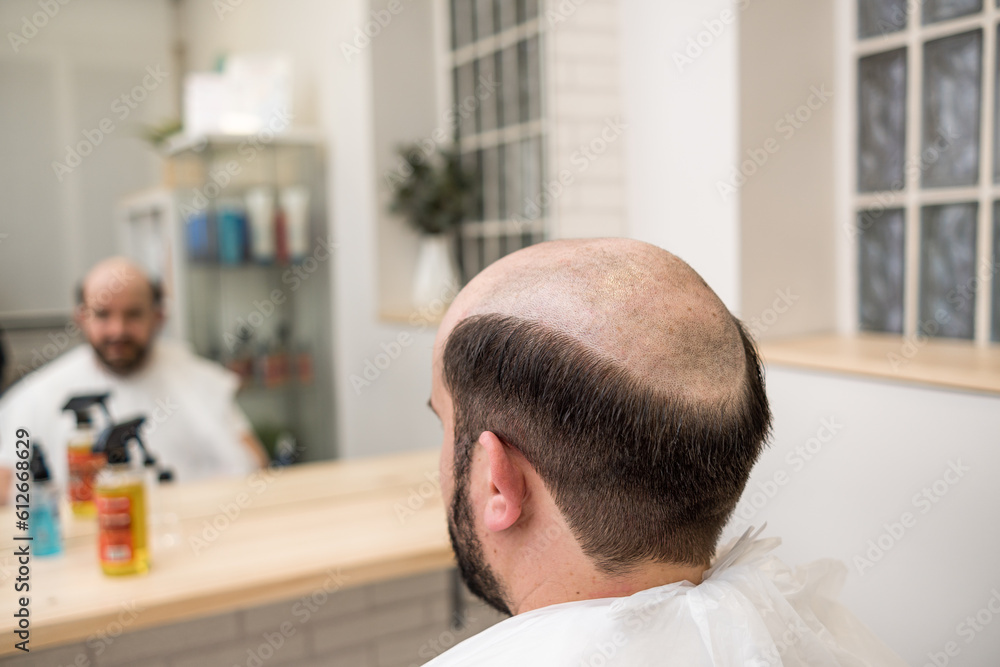 bald man waiting for his hair prosthesis to be placed in an esthetic c ...