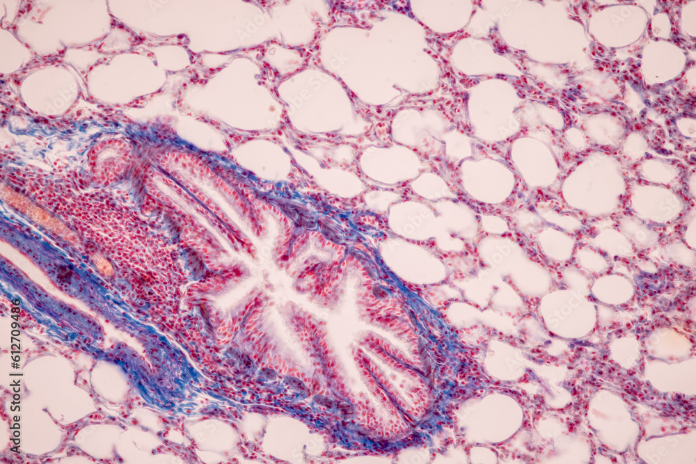 Fotografia do Stock: Human lung pathology under light microscope, The ...