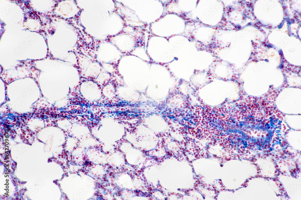 Human lung pathology under light microscope, The lungs is organs of the ...