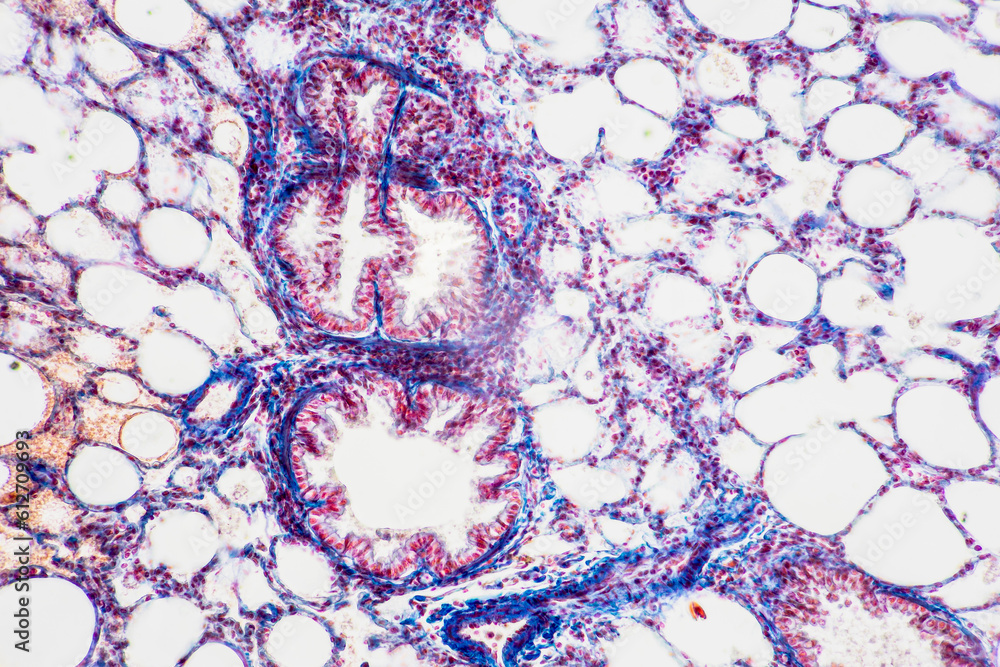 Human lung pathology under light microscope, The lungs is organs of the ...