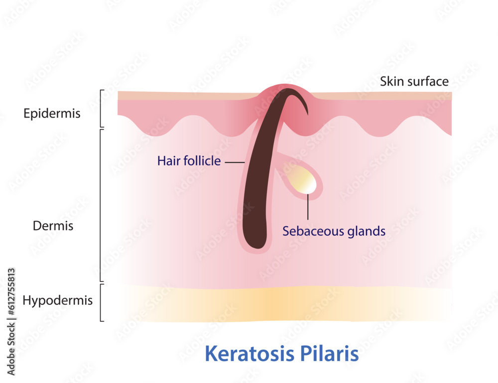 Keratosis Pilaris Ingrown Hair Chicken Skin Vector Illustration