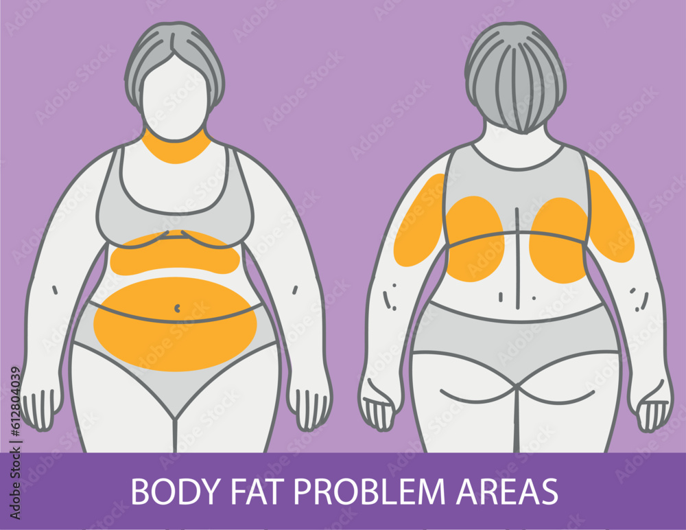 Body fat problem areas. Medical infographic. Healthcare illustration ...