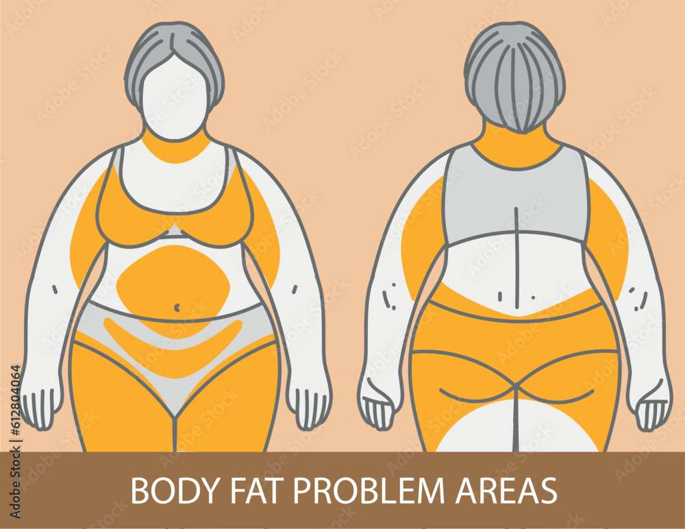 Body fat problem areas. Medical infographic. Healthcare illustration ...