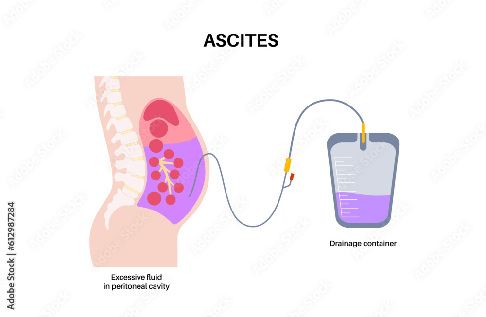 Abdominal paracentesis poster Stock Vector | Adobe Stock