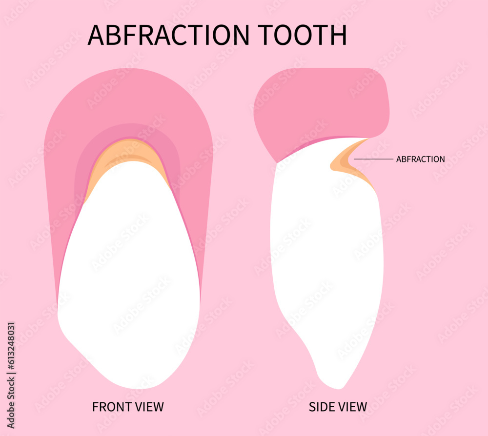 Toothache in dentistry with abfraction disease of teeth fracture crack ...