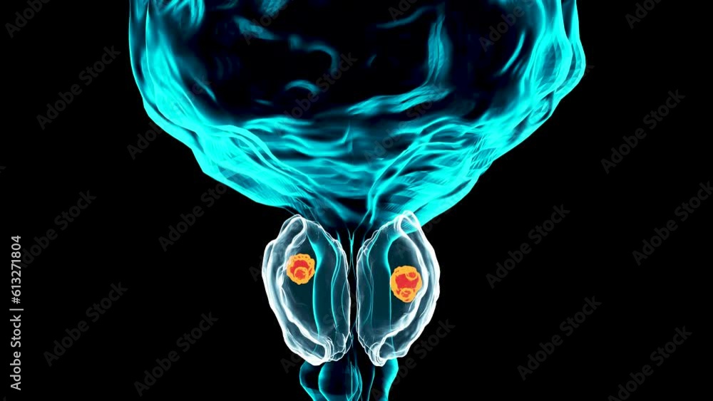 Prostate cancer stages. ancerous cells, malignant tumor compresses ...