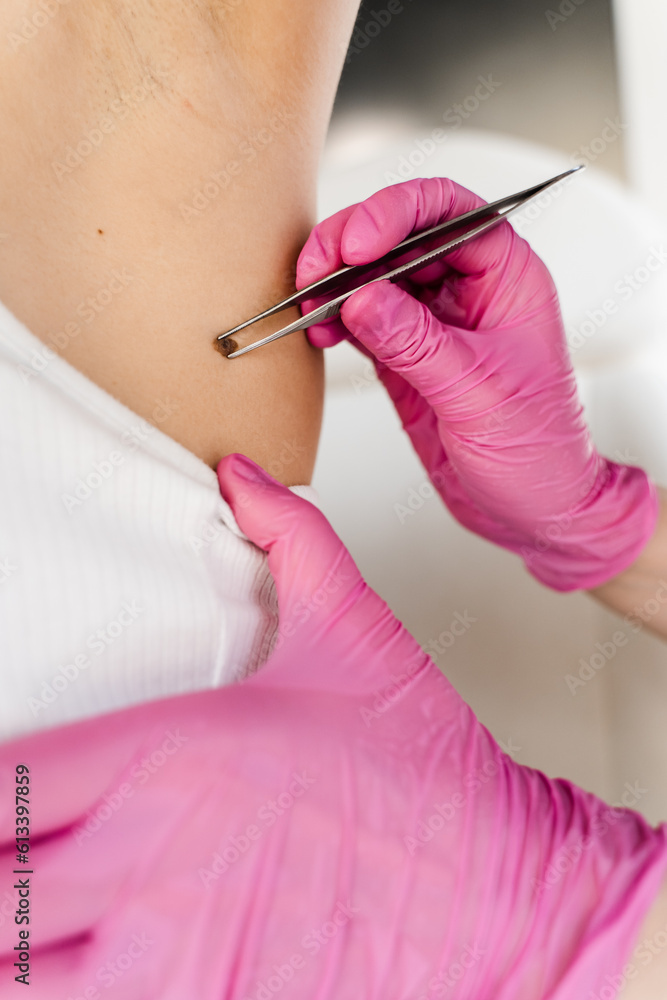 Dermatologist examines moles or birthmark of girl patient for revention ...