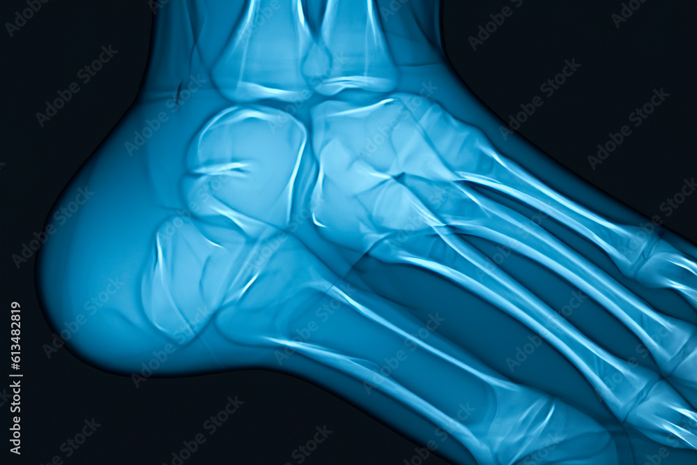 X-ray. X-ray of head, foot, head, mouth, ribs and hands. Bone scan ...