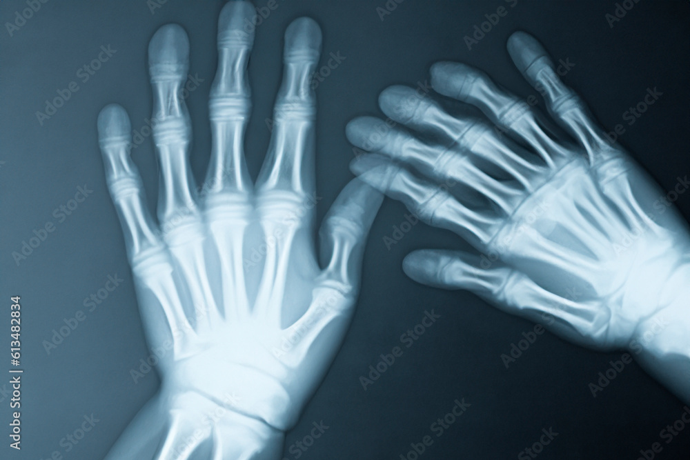 X-ray. X-ray of head, foot, head, mouth, ribs and hands. Bone scan ...