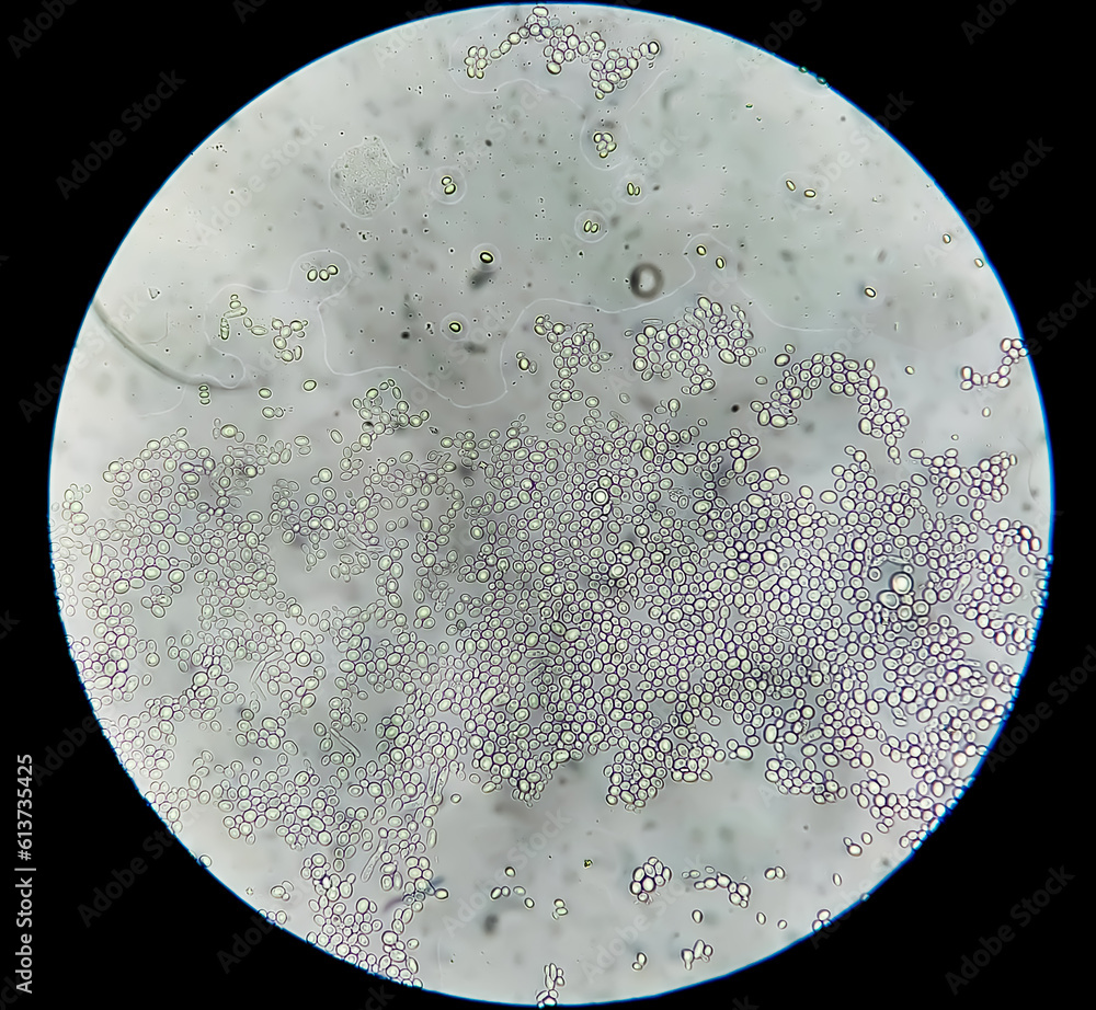 Budding yeast cells in patient urine (urinary tract infections ...