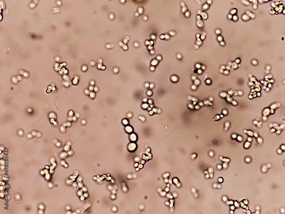 Budding yeast cells in patient urine (urinary tract infections ...