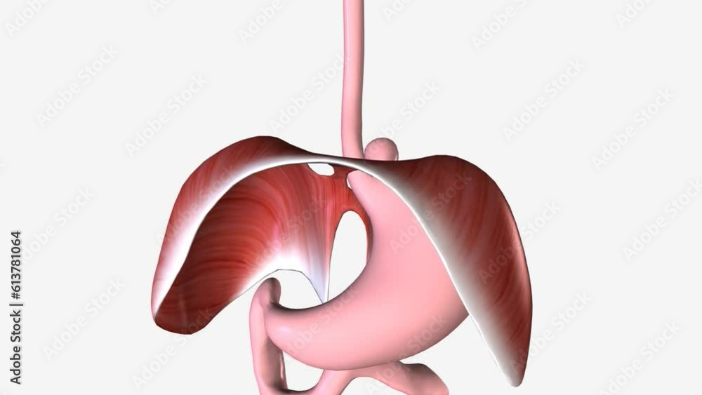 Paraesophageal hernia or hiatal hernia occurs when a portion of the ...