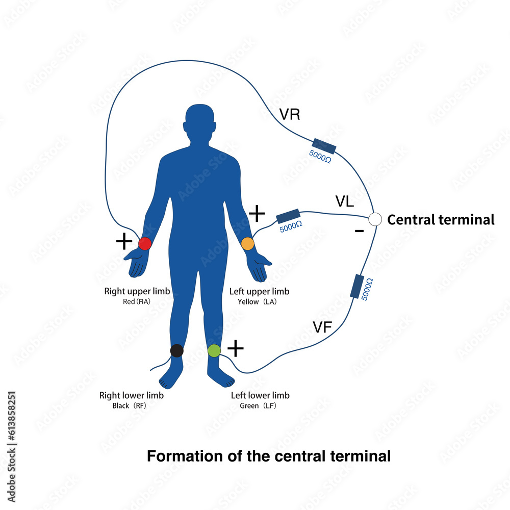 The wires of the left upper limb, right upper limb and left lower limb ...