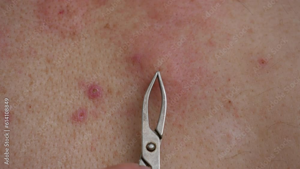 The process of extracting bee sting from the human body. Bee stings for ...