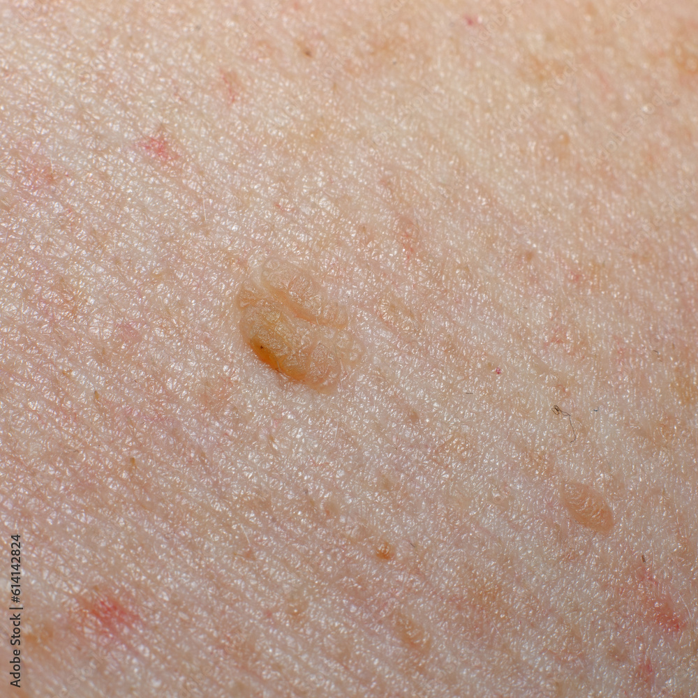 Nevus or mole on the human body close-up. Skin cancer, keratosis or ...
