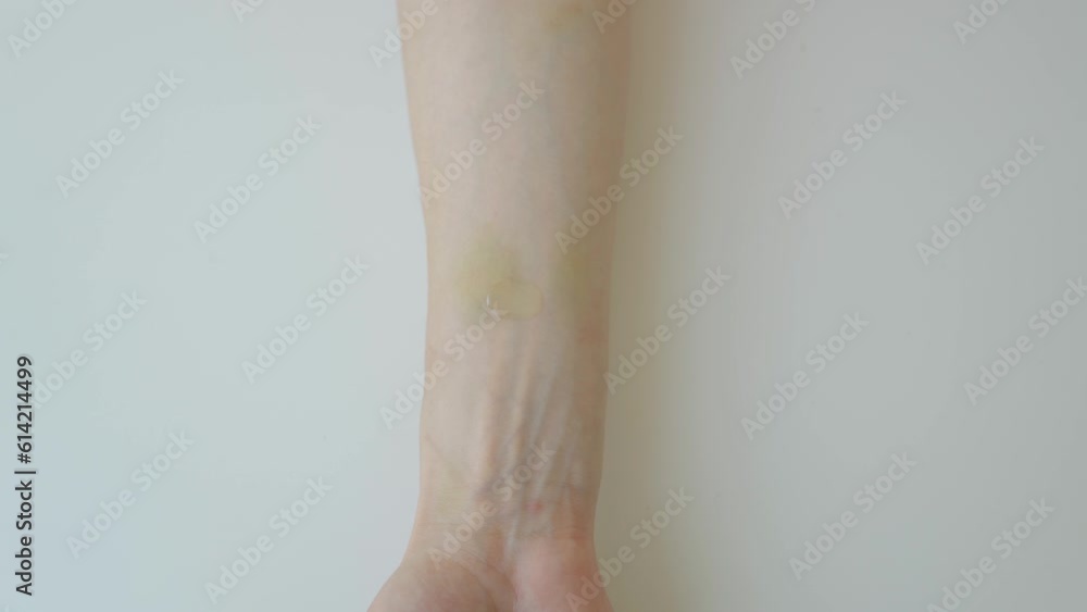 Girl hand smears bruise ointment close up. A caucasian woman applies a ...
