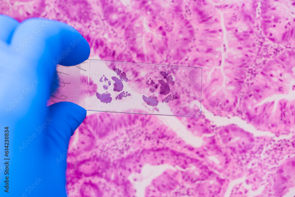 Scientist in blue gloves hand holding glasses slide breast tissue on ...