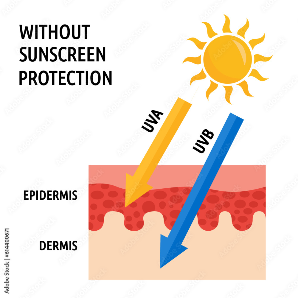 Diagram of UVA and UVB rays on human skin without sunscreen protection ...