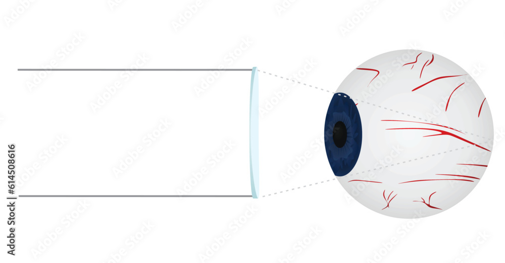 Poster How myopia lens change eyesight. vector – Wall Art | UkPosters