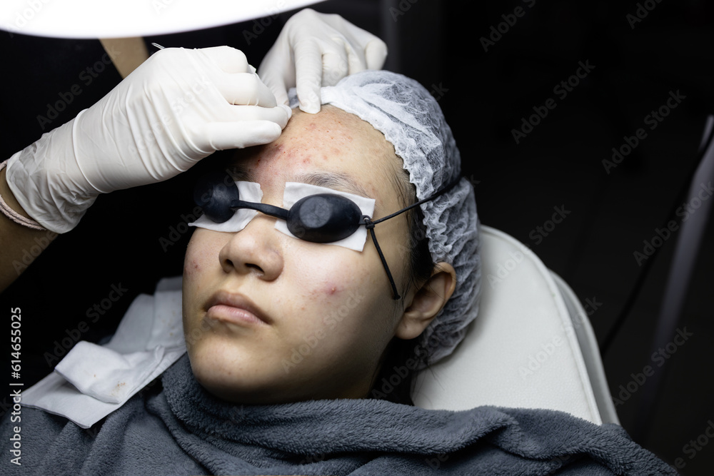 Young woman lying on bed doing facial skin care,pimple extraction ...