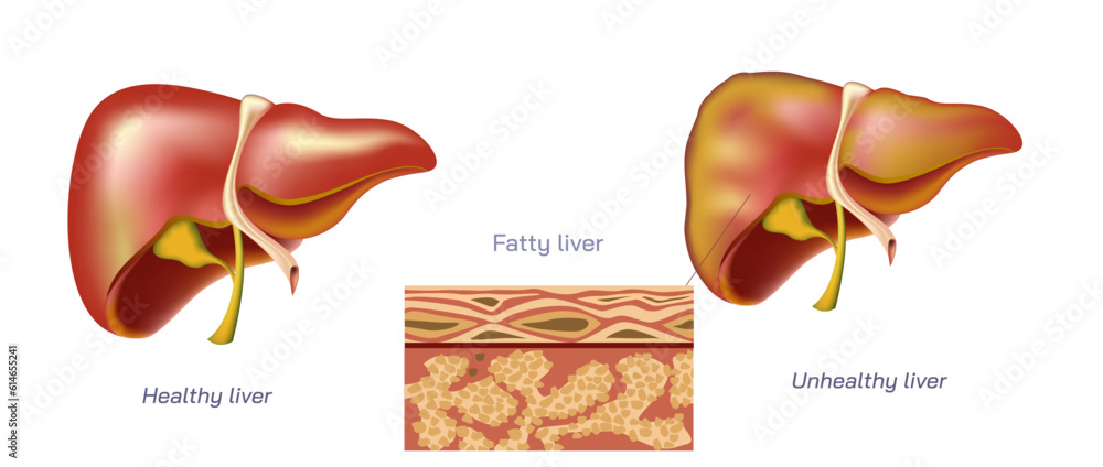 Unhealthy Human Liver