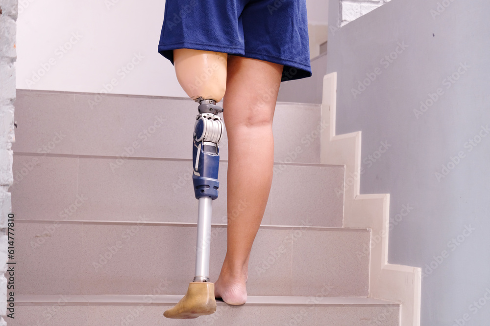 Disabled woman with prosthetic legs prosthetic leg concept. Stock Photo ...
