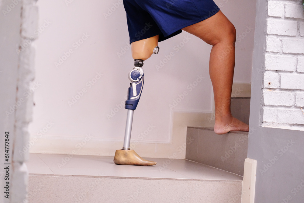 Disabled woman with prosthetic legs prosthetic leg concept. Stock Photo ...